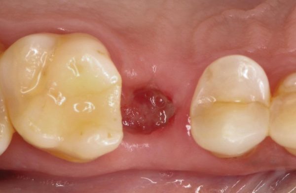 Healing Stages Of A Normal Socket After Tooth Extraction A Complete Guide To Recovery And Care