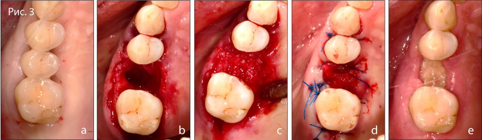 Healing Stages of a Normal Socket After Tooth Extraction: A Complete ...